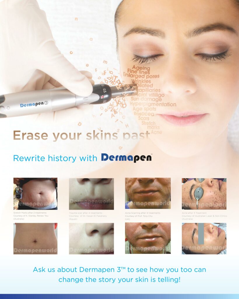 Dermapen - Birgit Muylle